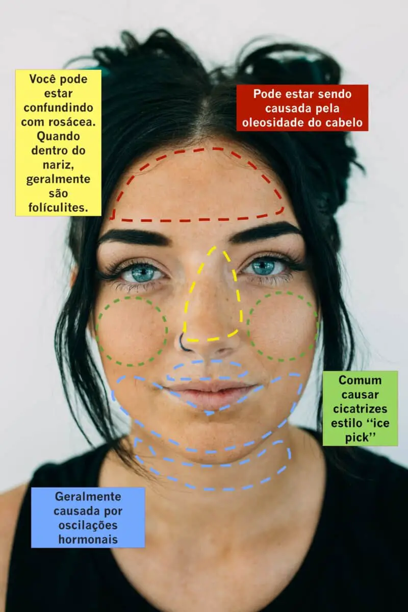 Mapa das Espinhas: O que o Local da Sua Acne Pode Dizer Sobre Ela ...