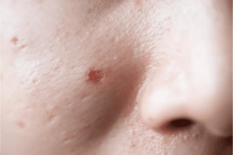 Por que minha Espinha virou um Caroço? Dermato Explica – Protocolo da Pele