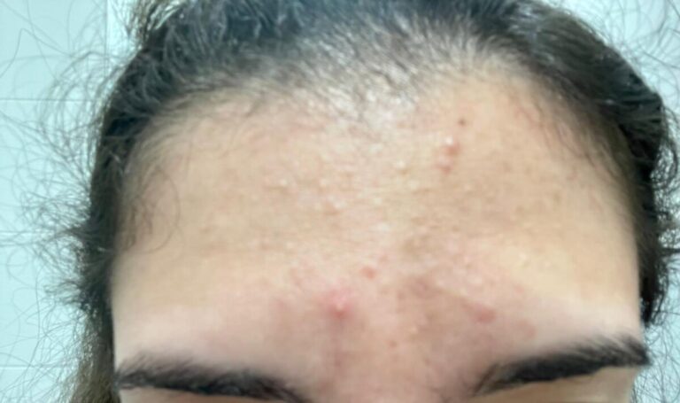 O que é Pior: Espinha Interna ou Externa? E como Tratá-las? – Protocolo ...