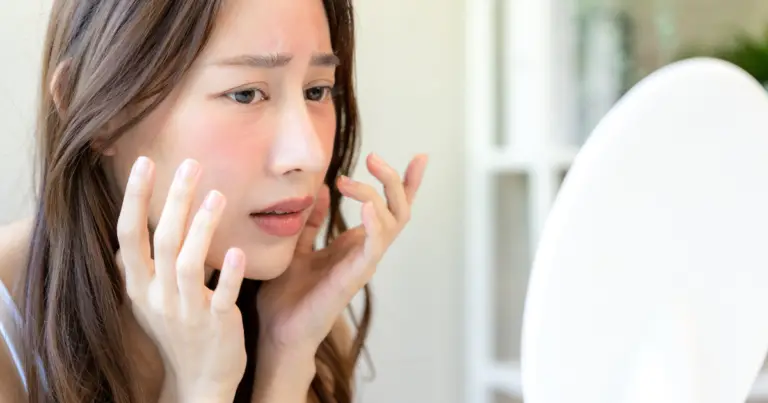 Tudo sobre Rosácea: Como Tratar e Melhores Produtos – Protocolo da Pele