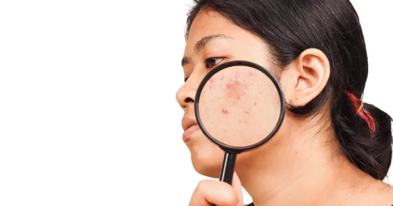 Como Tratar Espinha Interna? Dermato Responde – Protocolo da Pele