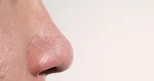 O que é um comedão? Por que eles se Formam? – Protocolo da Pele